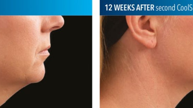 Frozen Dreams: Unveiling the Magic of Cool Sculpting - Ruse Global